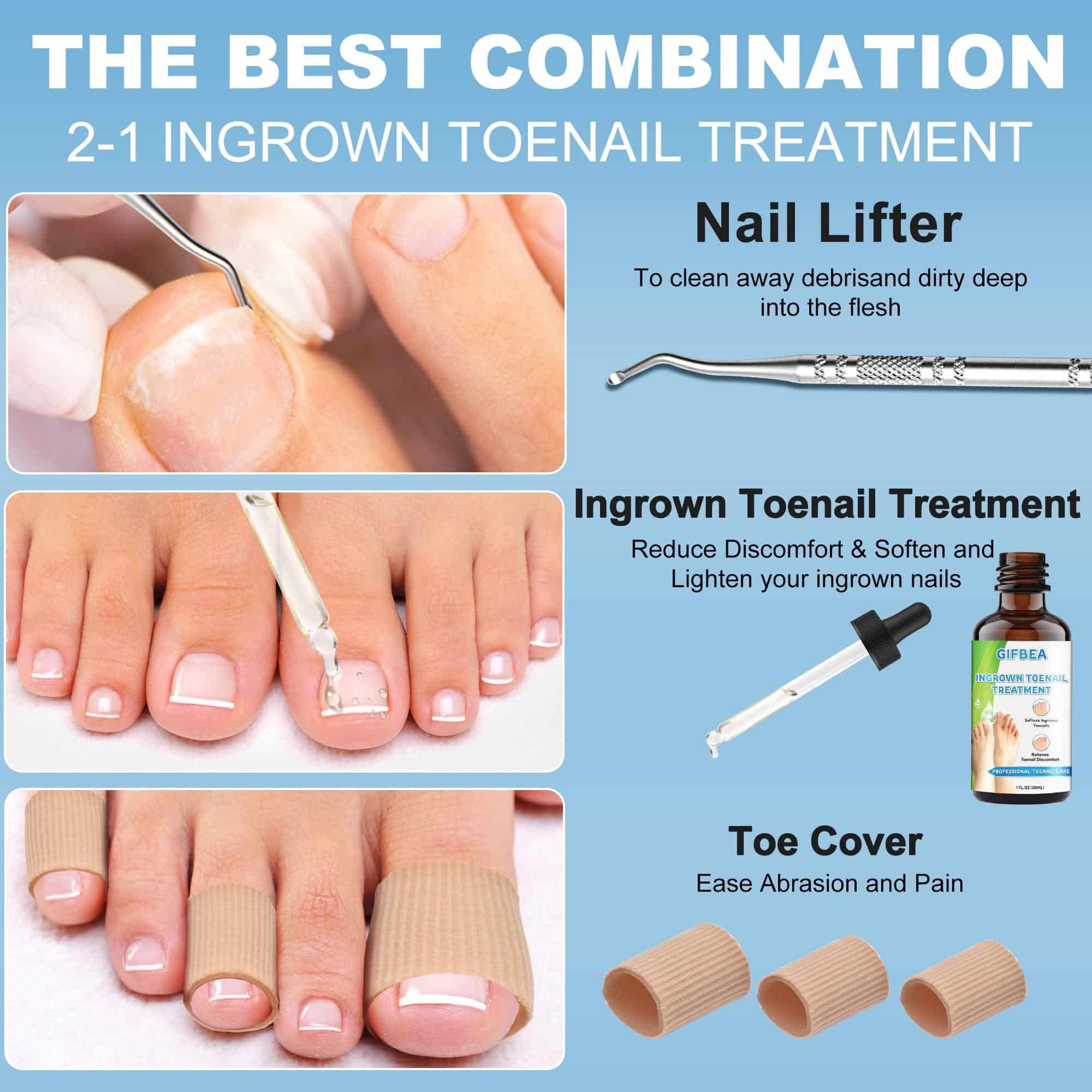 How To Fix Ingrown Nail ? - My Glow Journey