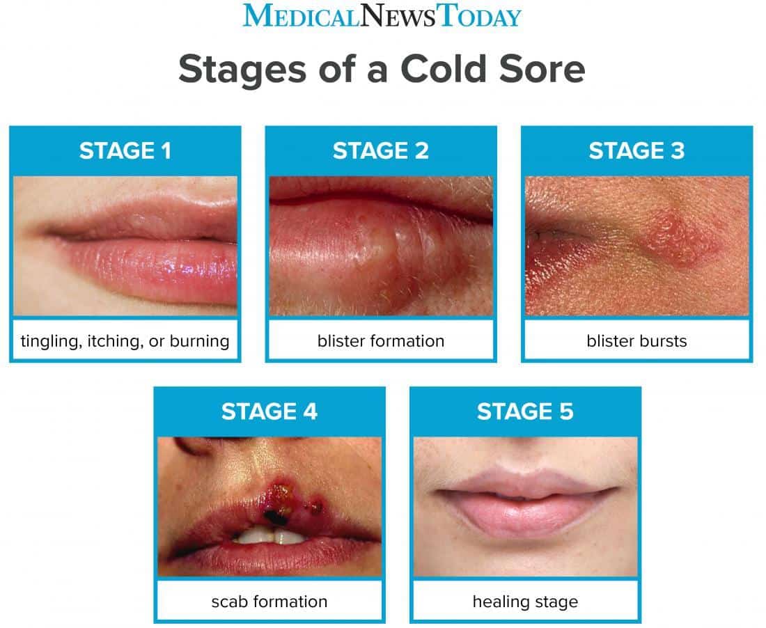 How To Conceal A Cold Sore With Makeup ? - My Glow Journey