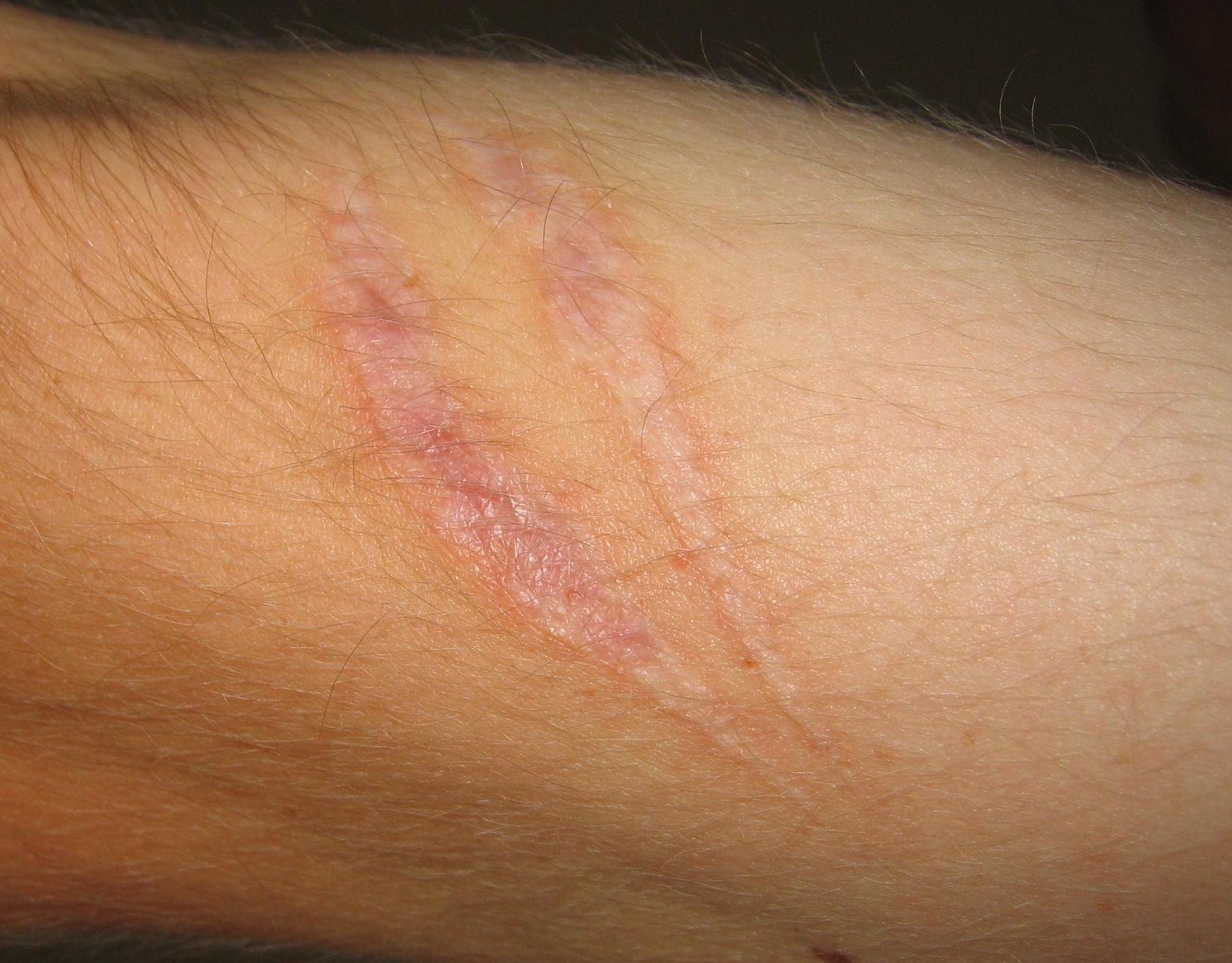How To Cover Scars With Makeup ? - My Glow Journey