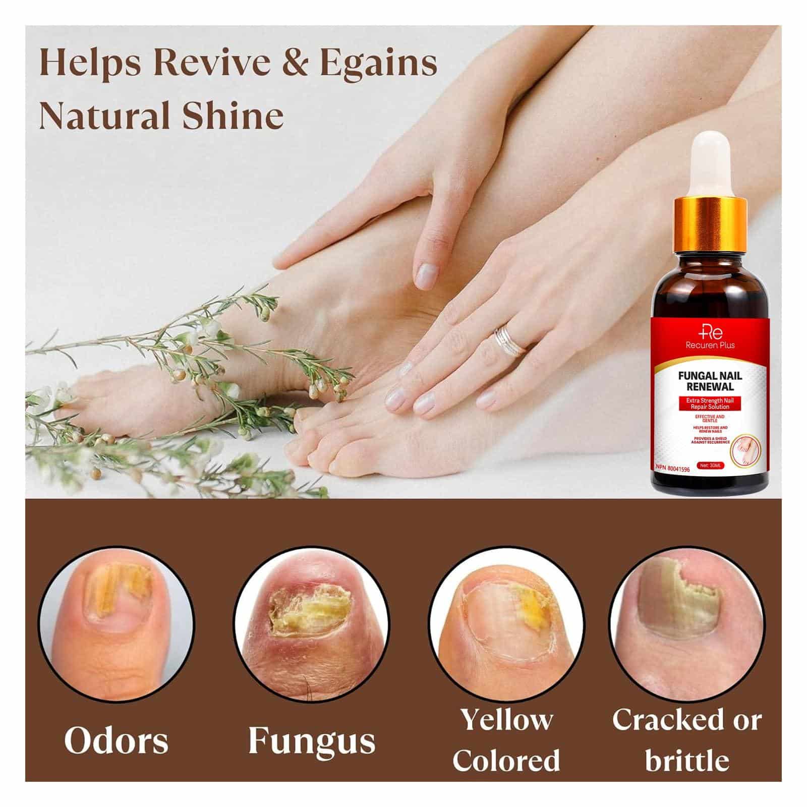 How To Treat Nail Fungus Fast ? - My Glow Journey