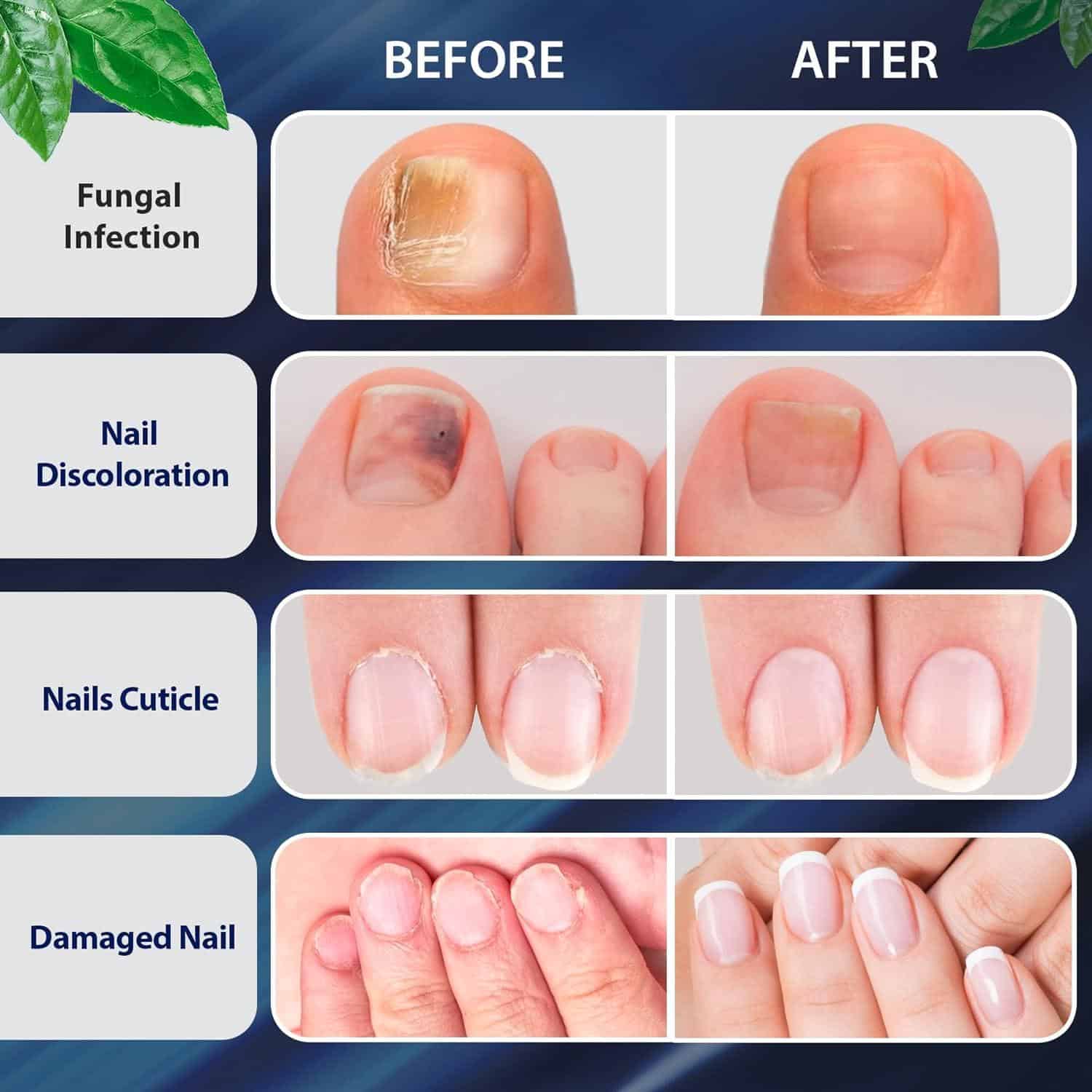How To Get Rid Of Nail Fungus From Artificial Nails ? - My Glow Journey