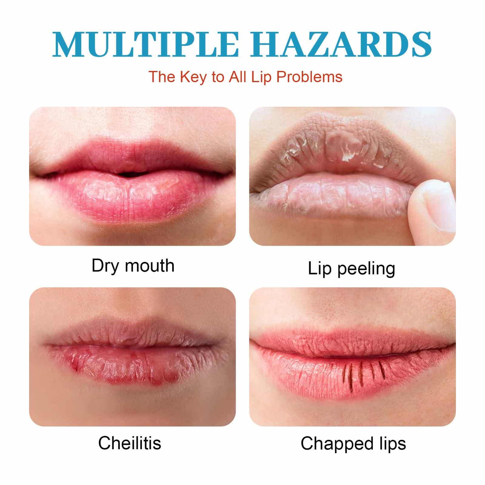 What Is Cause Of Dry Lips ? - My Glow Journey